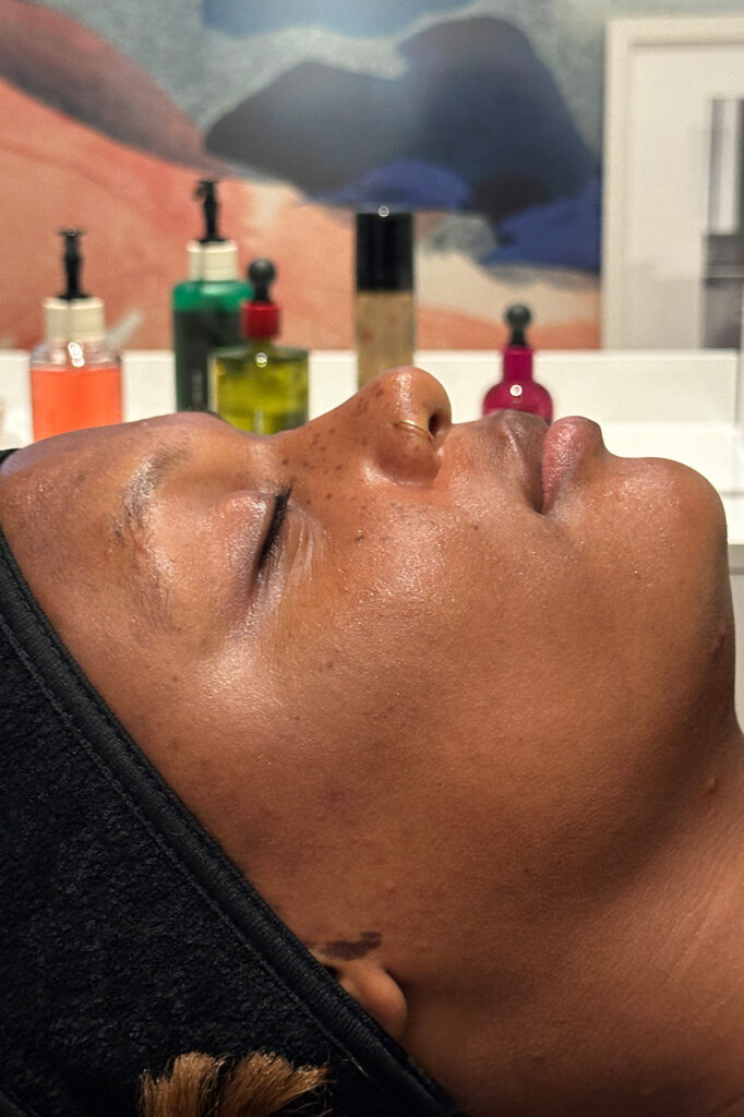 Chemical Peels, Decoded | Brooklyn Face & Eye